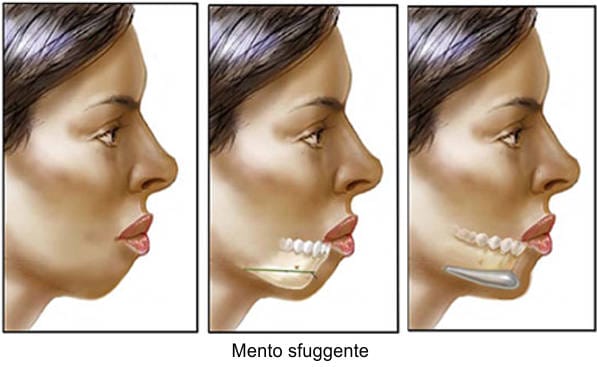 mentoplastica additiva - OrtognaticaRoma