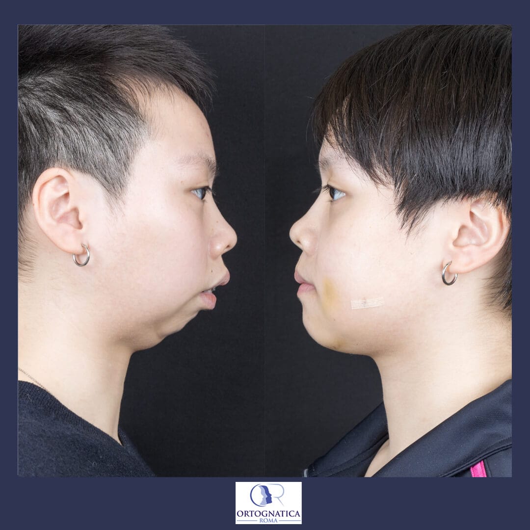 Filler Mento a Roma: cosa c'è da sapere? - OrtognaticaRoma