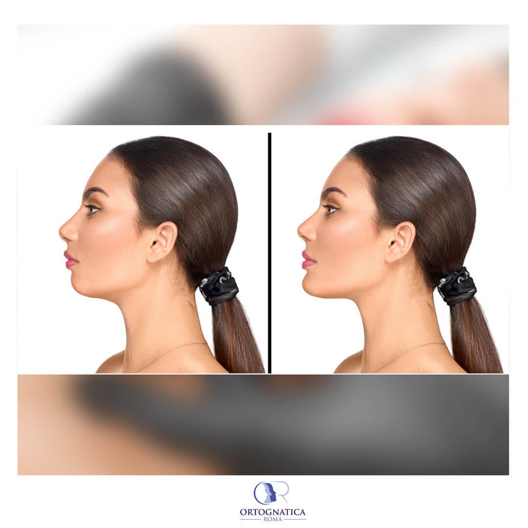 Filler Mento a Roma: cosa c'è da sapere? - OrtognaticaRoma