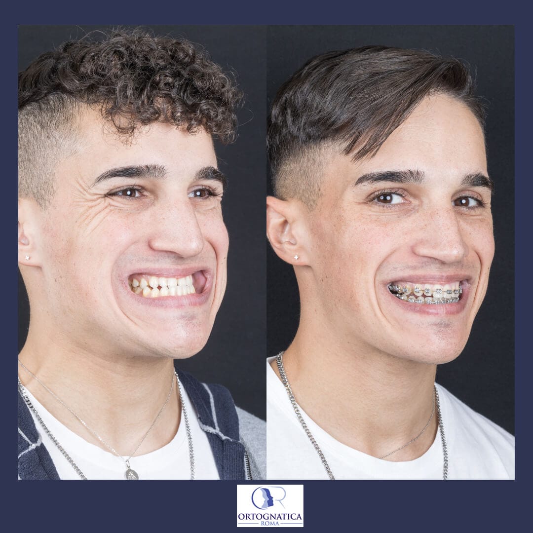 Protrusione Mandibola: cos'è e come curarla? - OrtognaticaRoma