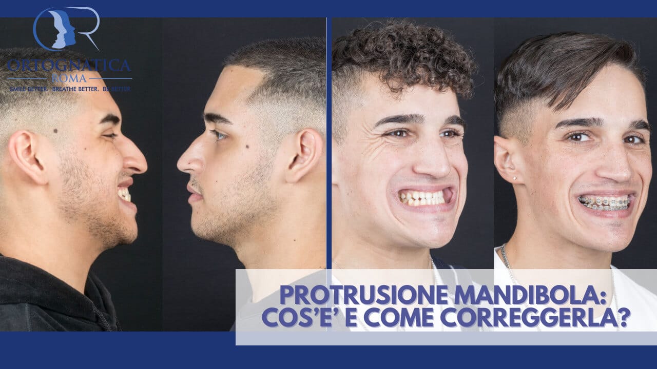 Protrusione Mandibola: cos'è e come curarla? - OrtognaticaRoma