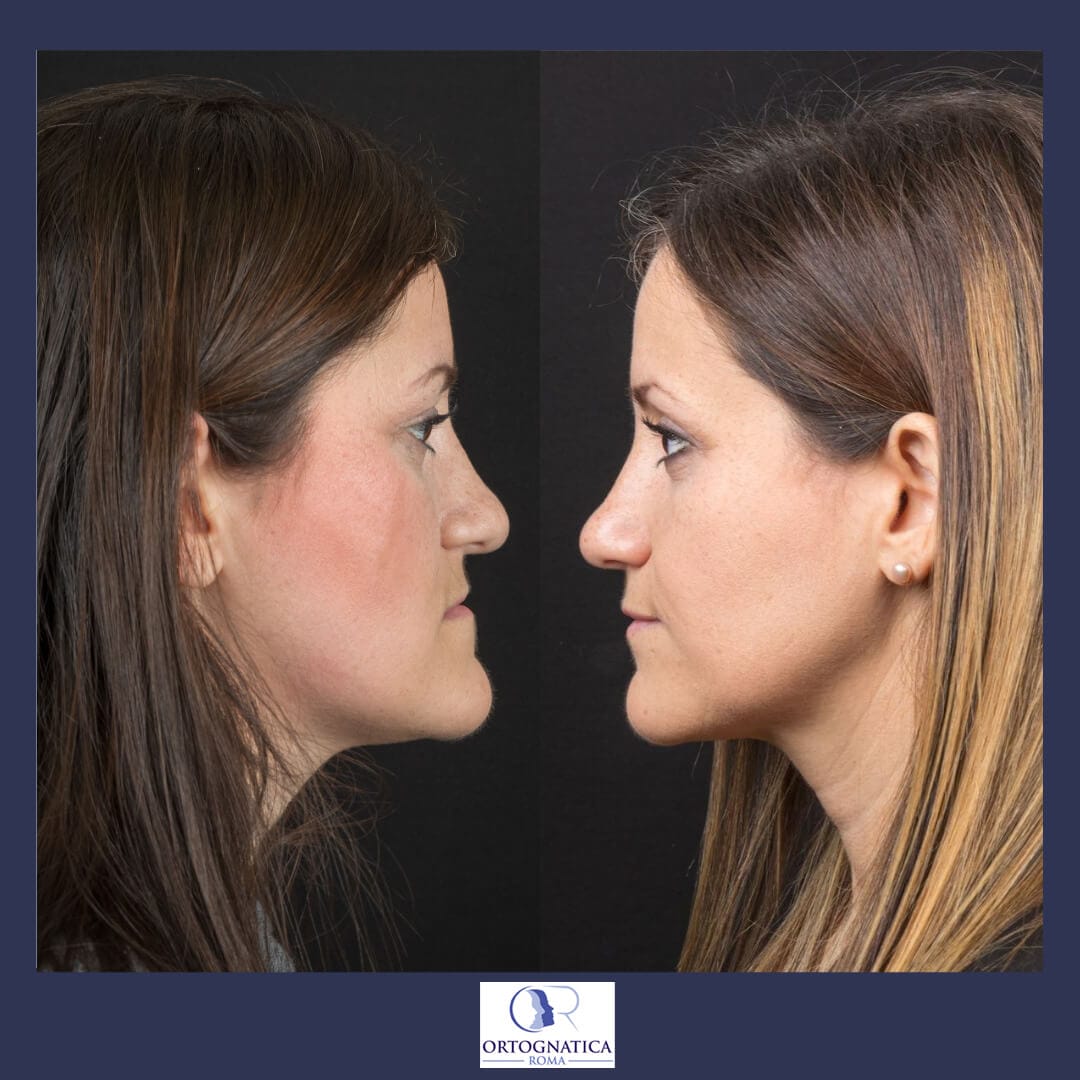 Protrusione Mandibola: cos'è e come curarla? - OrtognaticaRoma