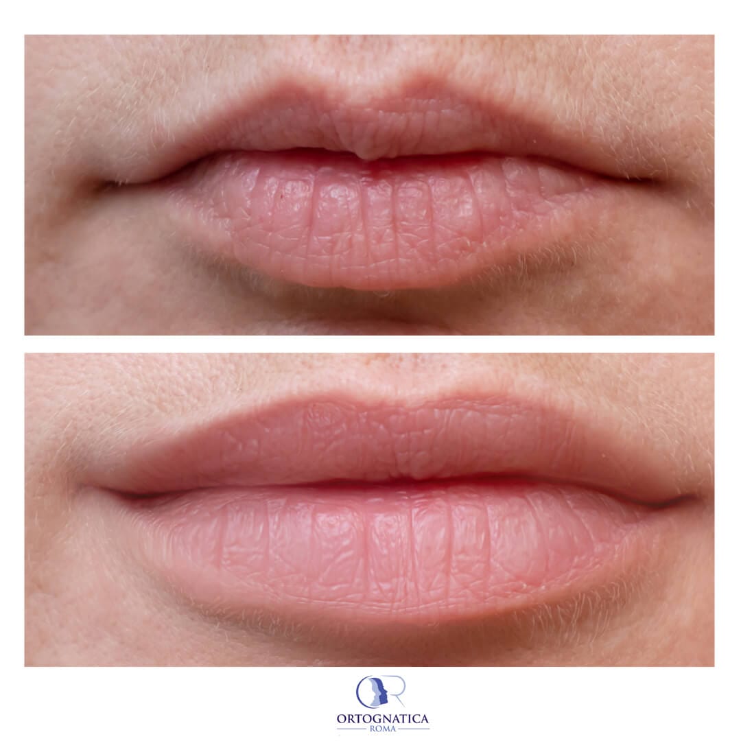 Filler labbra a Roma: 10 cose che devi sapere - OrtognaticaRoma