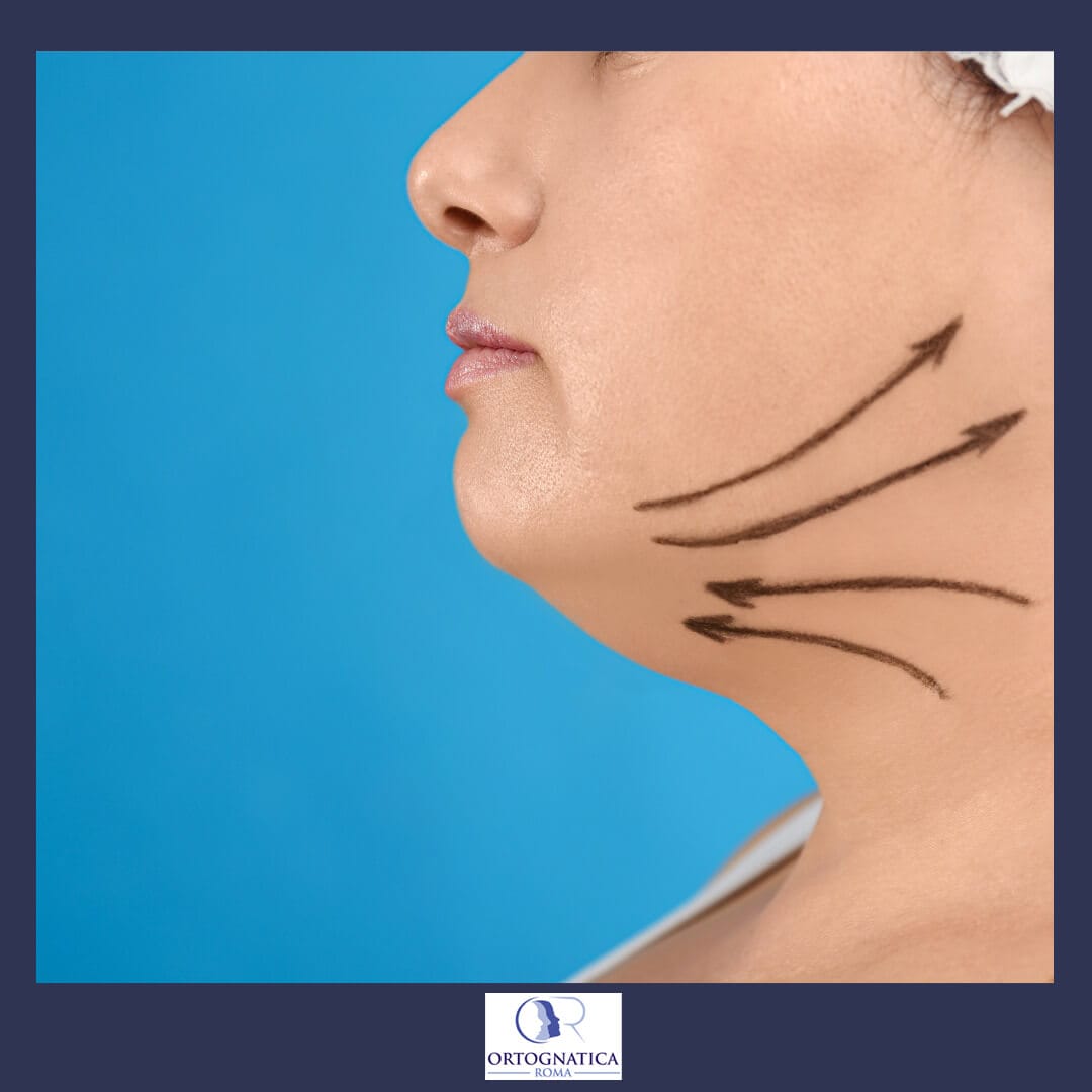 Doppio mento: cos'è e i trattamenti per eliminarlo - OrtognaticaRoma