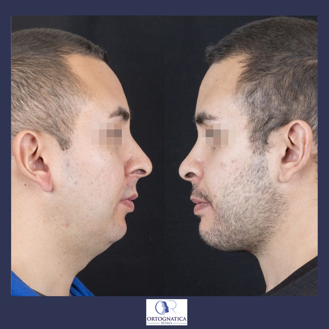 Doppio mento: cos'è e i trattamenti per eliminarlo - OrtognaticaRoma