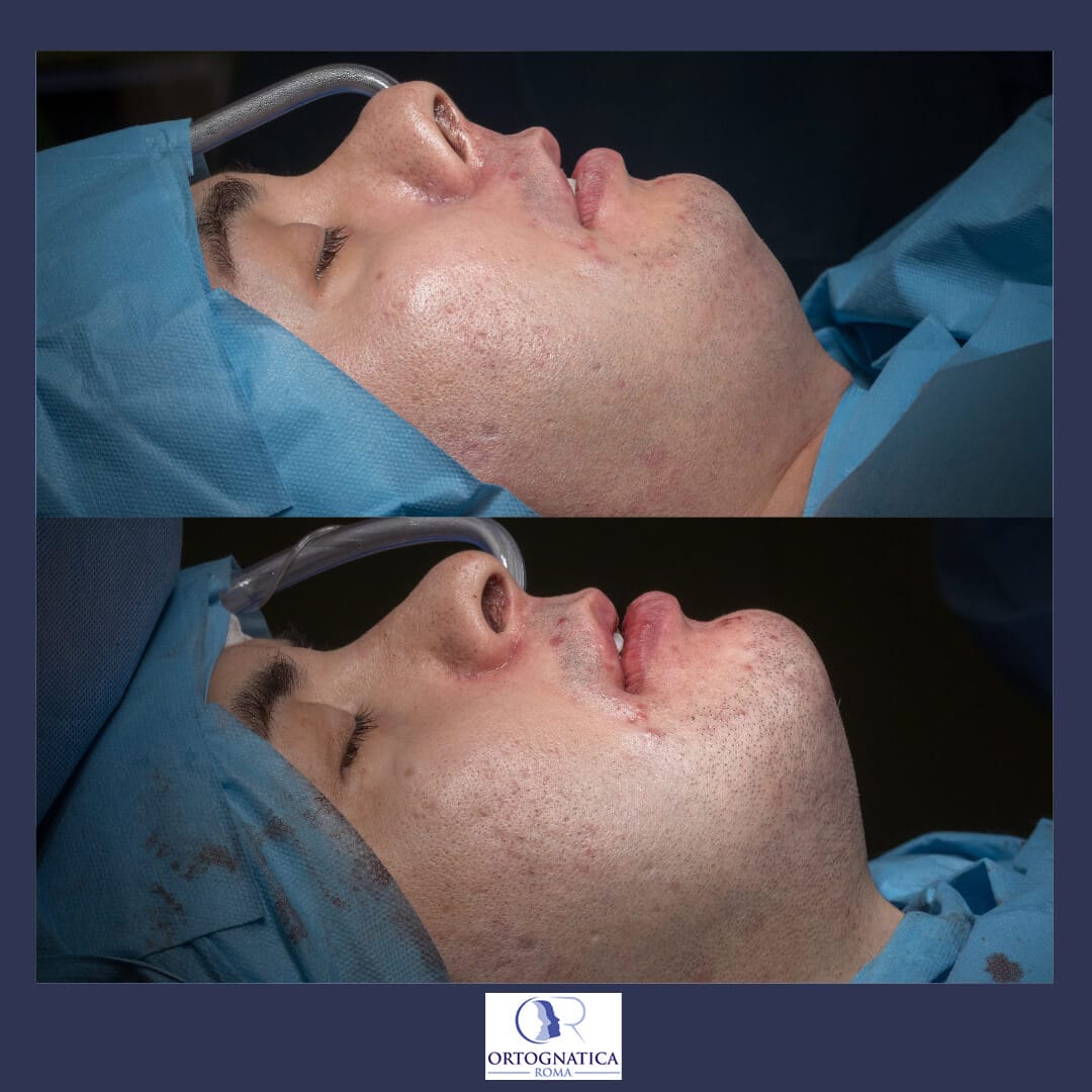 Doppio mento: cos'è e i trattamenti per eliminarlo - OrtognaticaRoma