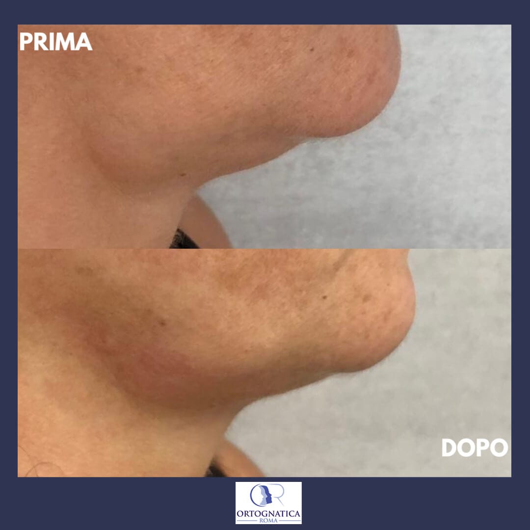 Doppio mento: cos'è e i trattamenti per eliminarlo - OrtognaticaRoma