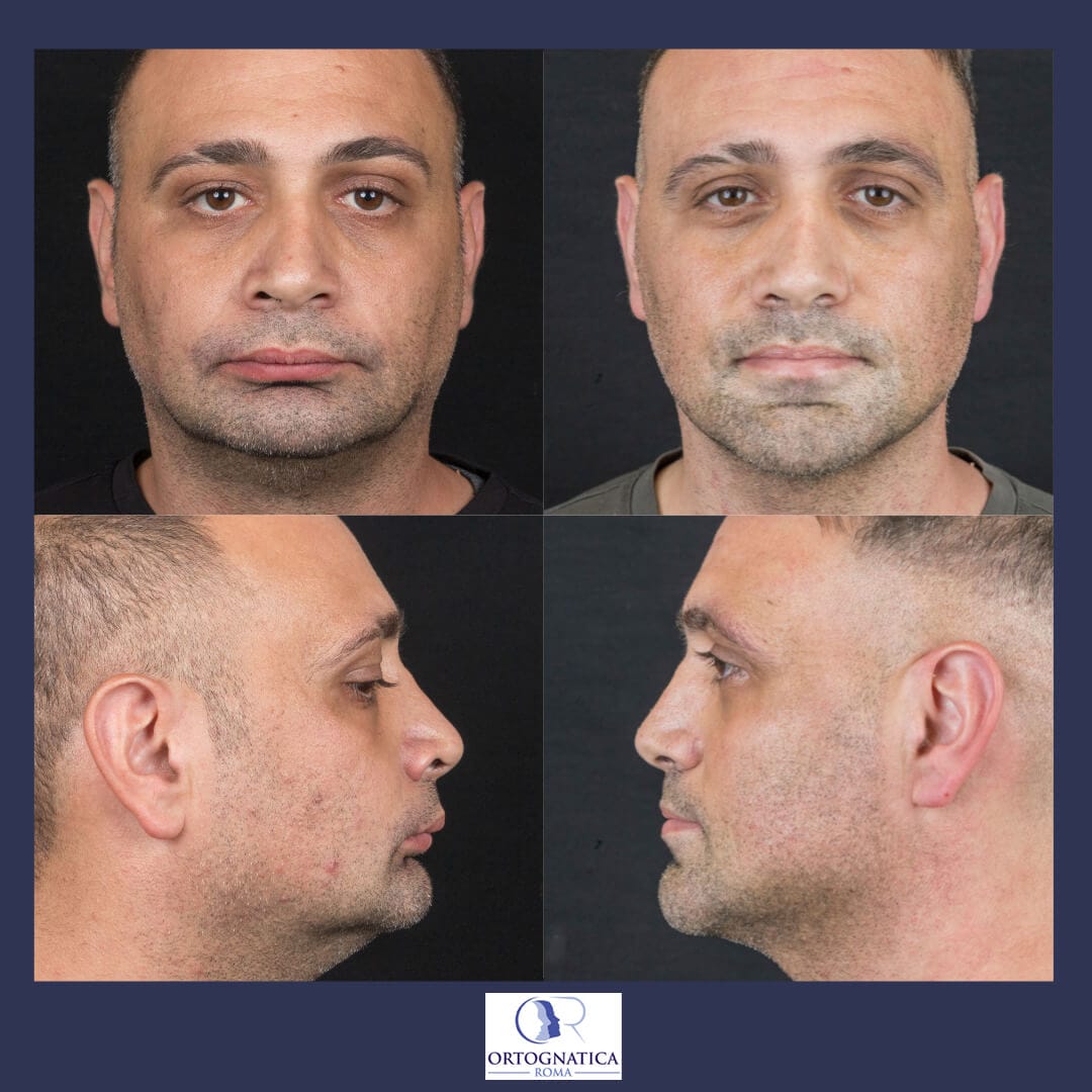 Chirurgia Maxillo-Facciale della Mandibola - OrtognaticaRoma