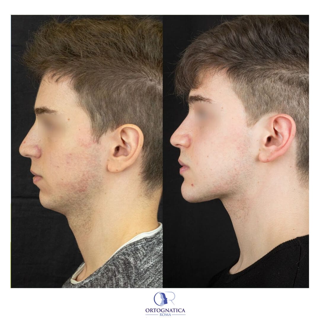 Chirurgia Maxillo-Facciale della Mandibola - OrtognaticaRoma