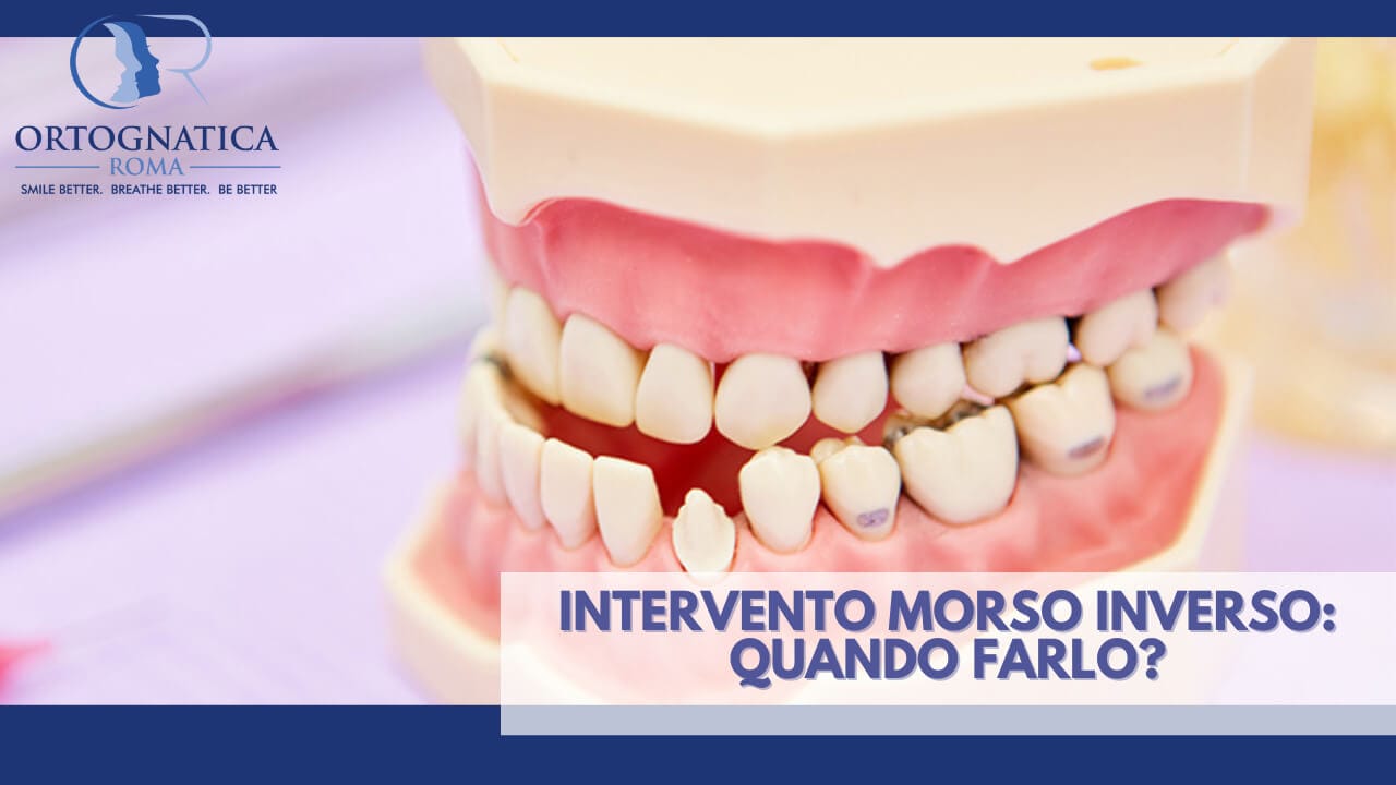 Intervento morso inverso: quando farlo? - OrtognaticaRoma