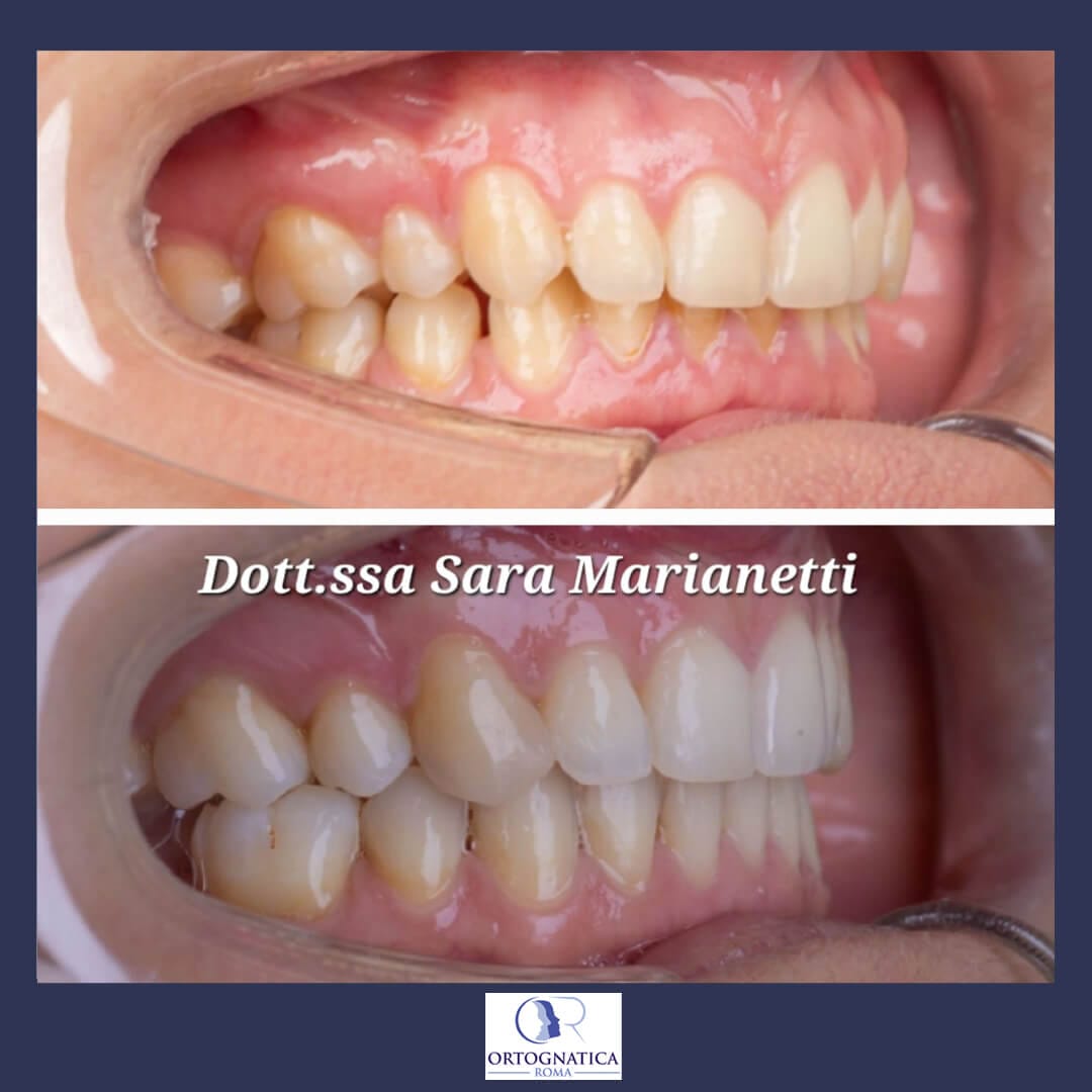 Morso Profondo: quando e come intervenire - OrtognaticaRoma